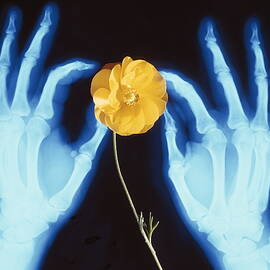 Degloving Injury by Mike Devlin / Science Photo Library