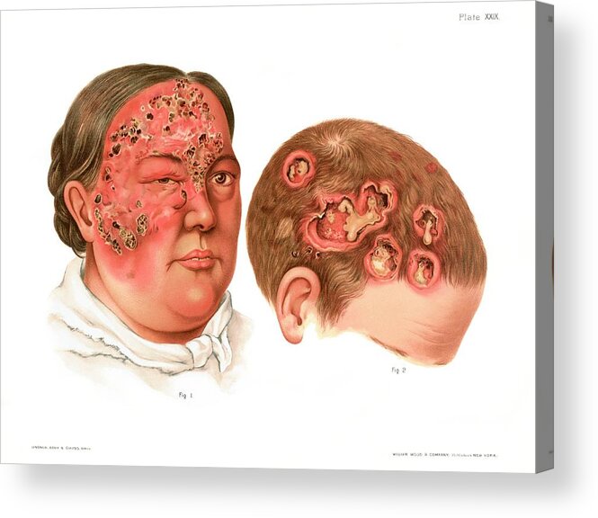 Tertiary Syphilis Lesions #1 Acrylic Print by Us National Library Of ...